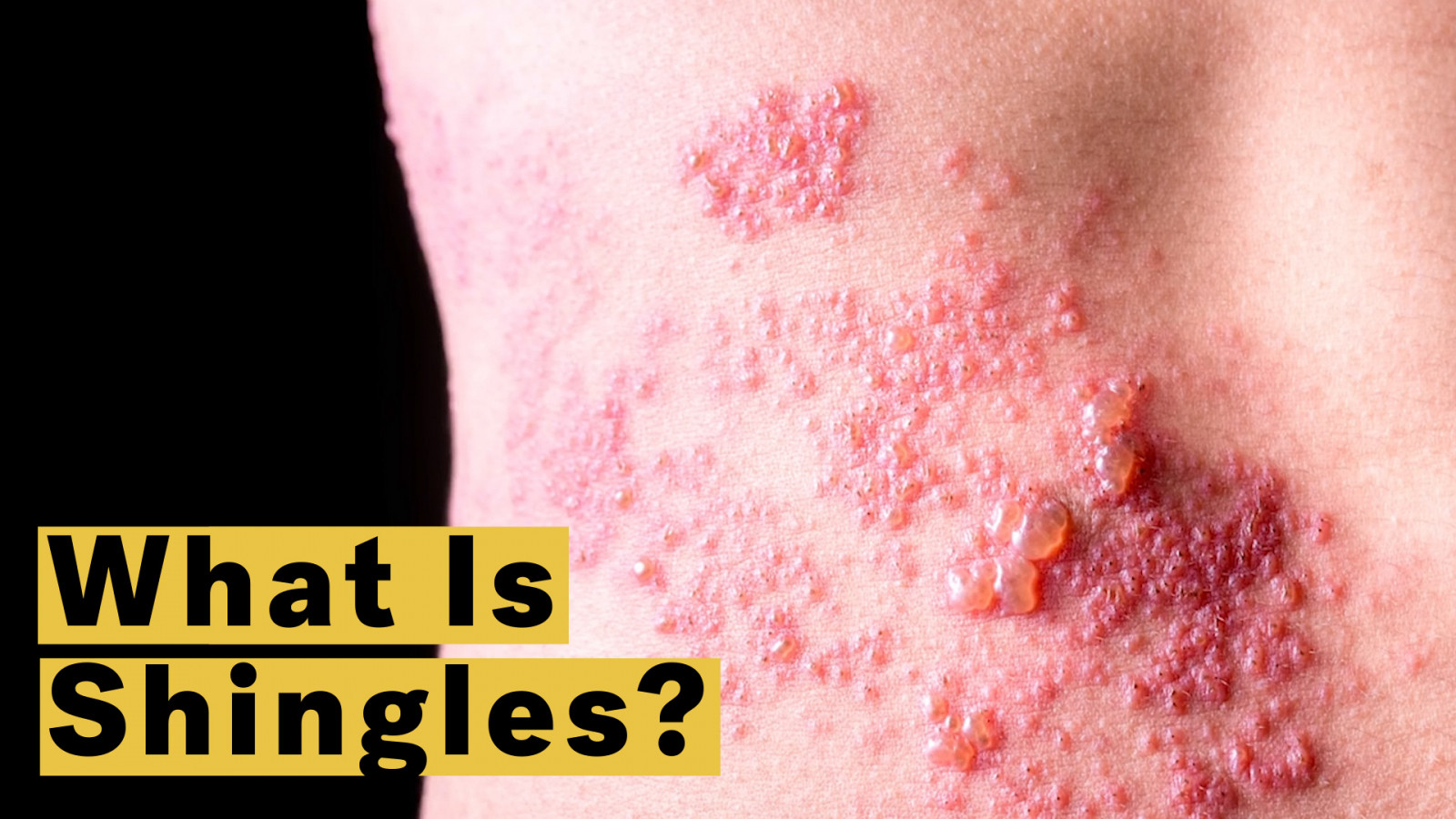 Stress Is Related To Shingles