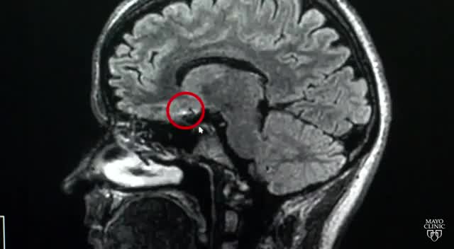 Mri Brain Aneurysm