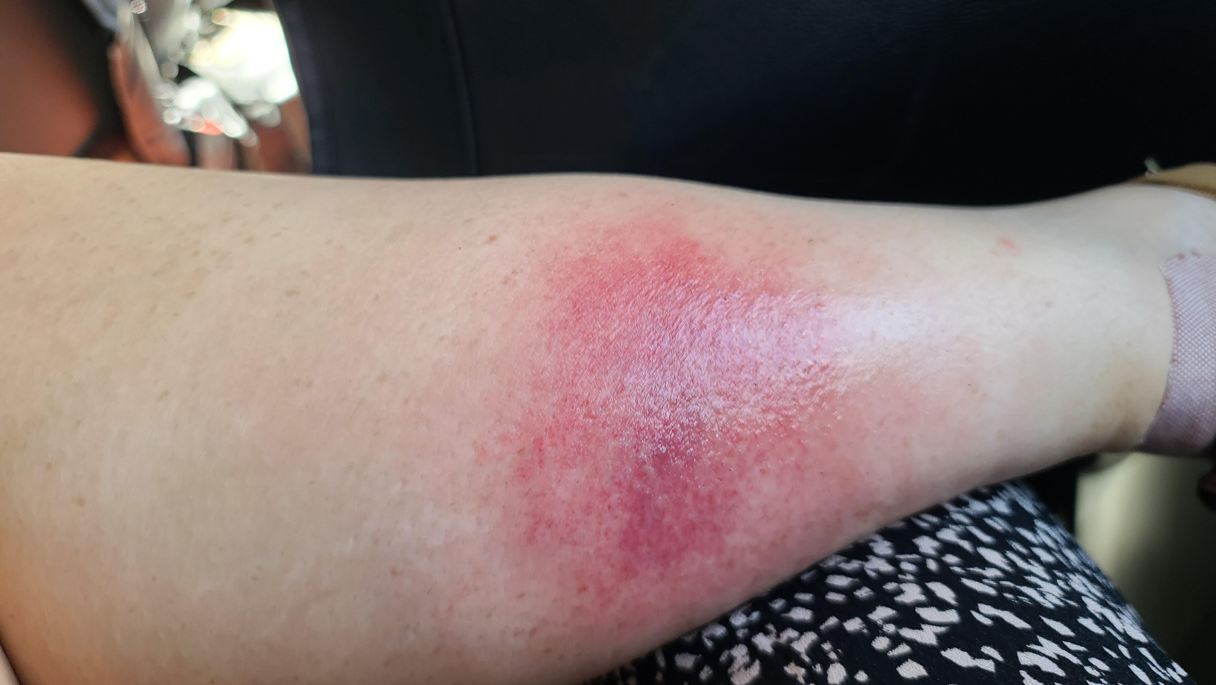 Mild Hornet Stings Mild Hornet Stings