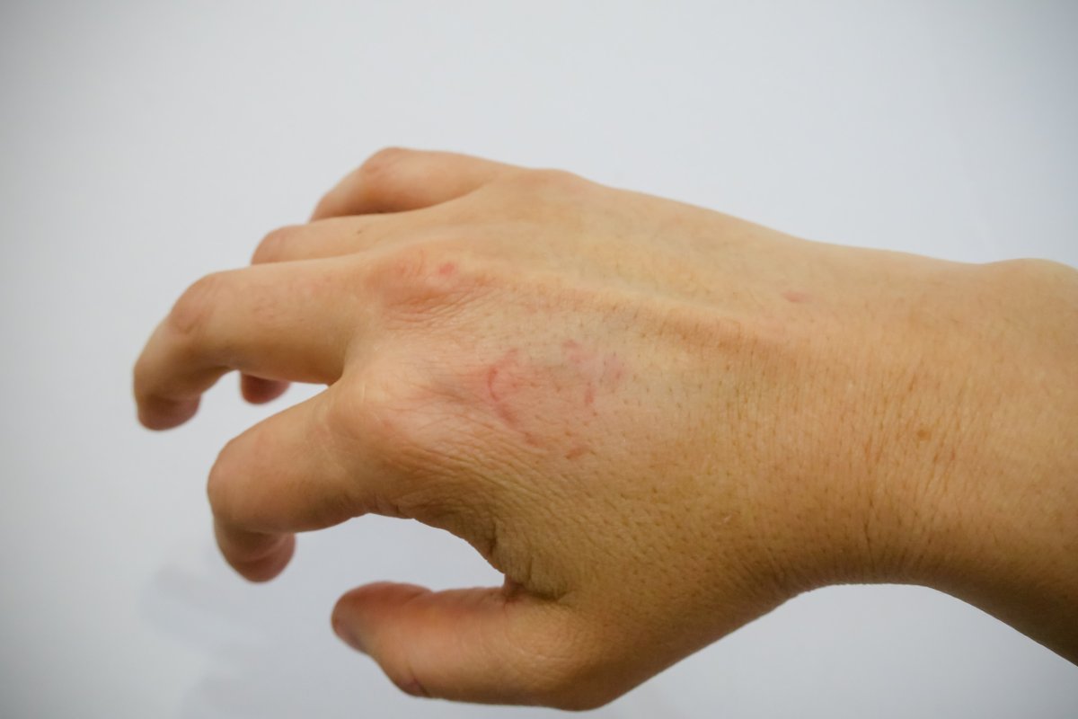 Florida Man Gets Flesh Eating Infection After Being Bitten In Fight
