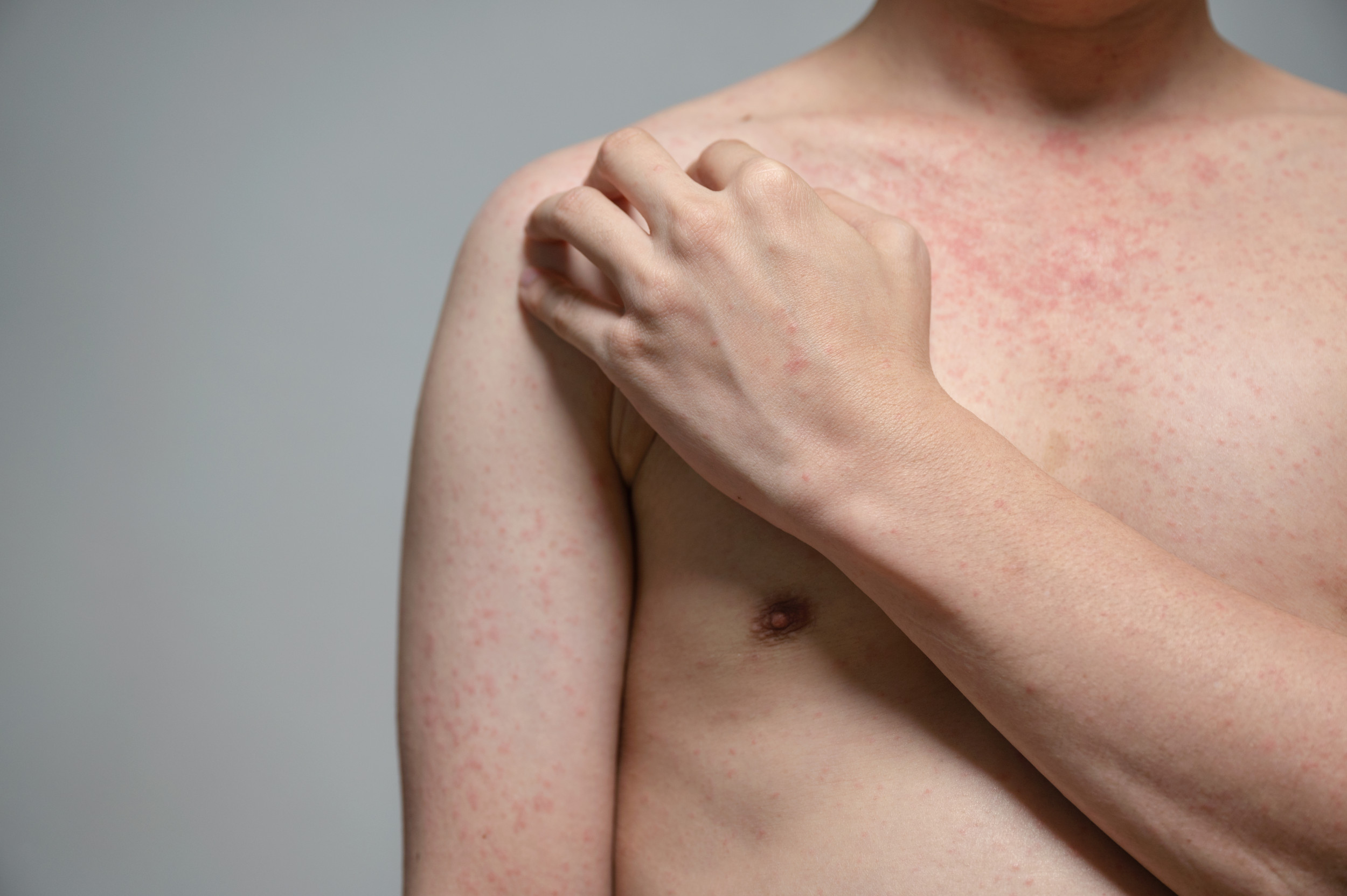 Measles Outbreak Map Shows States Where Cases Have Been Reported - Newsweek