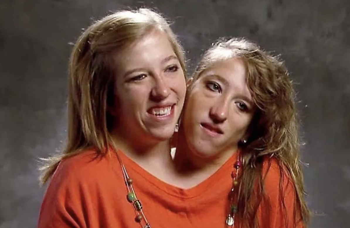 How Conjoined Twins Abby And Brittany Hensel Look Like Conjoined Twin How Conjoined Twins Abby And Brittany Hensel Look Like Conjoined Twin
