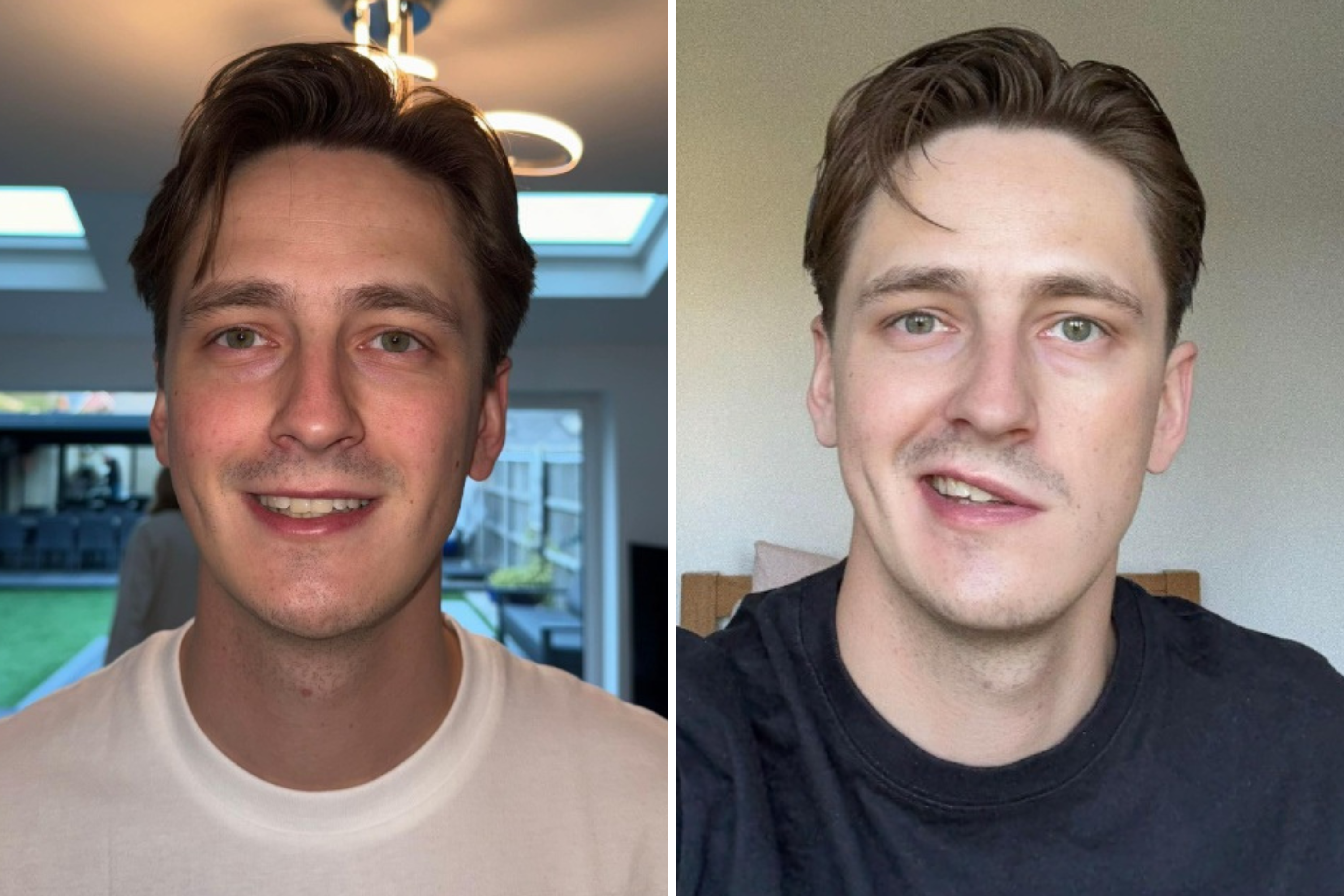 Man Goes to Sleep, Wakes Up With a 'Half Paralyzed Face' | BNN ...