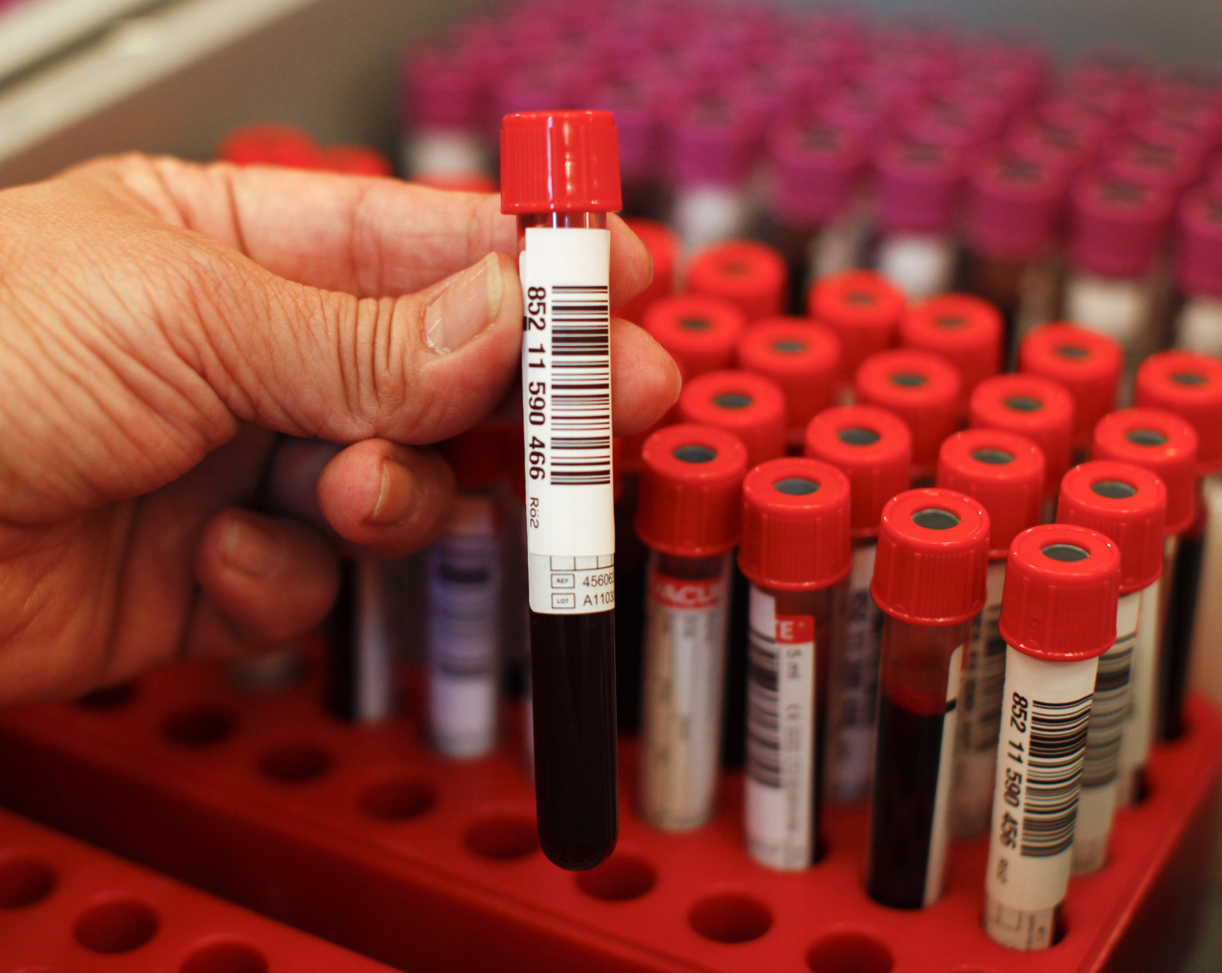 First Blood Test For Depression Holds Promise Of Objective Diagnosis First Blood Test For Depression Holds Promise Of Objective Diagnosis